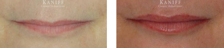 Dermal Fillers Sacramento - Vollure - Voluma - Juvederm - Restylane ...